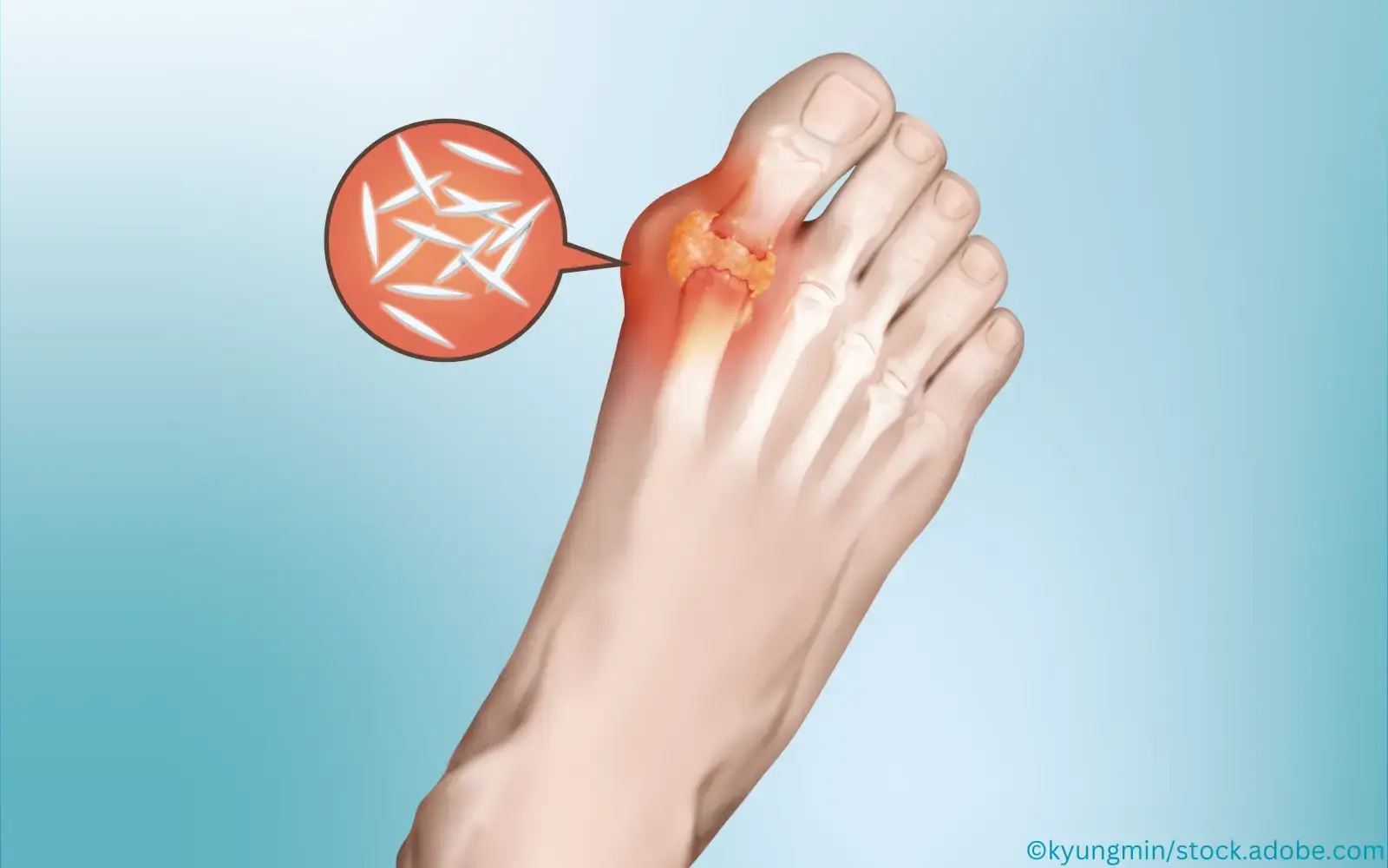 Gicht-Remission: Nutzen einer Colchicin-Prophylaxe | Gelbe Liste