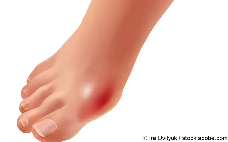 Hallux Bunion (Hallux Valgus) | NHS Fife