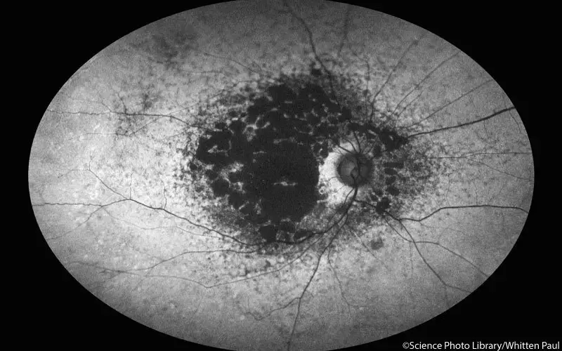 Hereditäre Makuladystrophien | Gelbe Liste