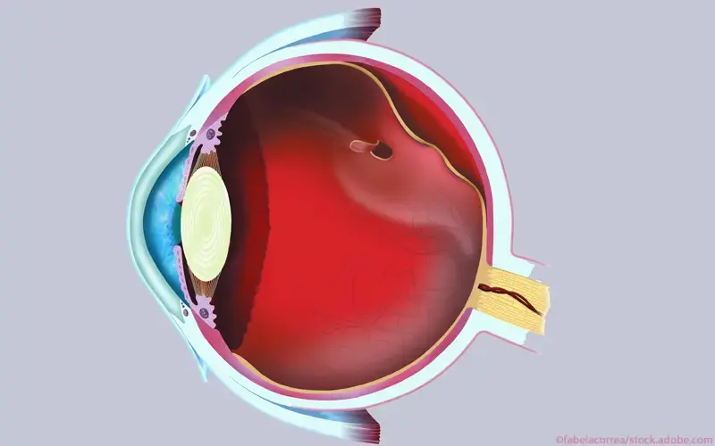 Netzhautablösung | Gelbe Liste
