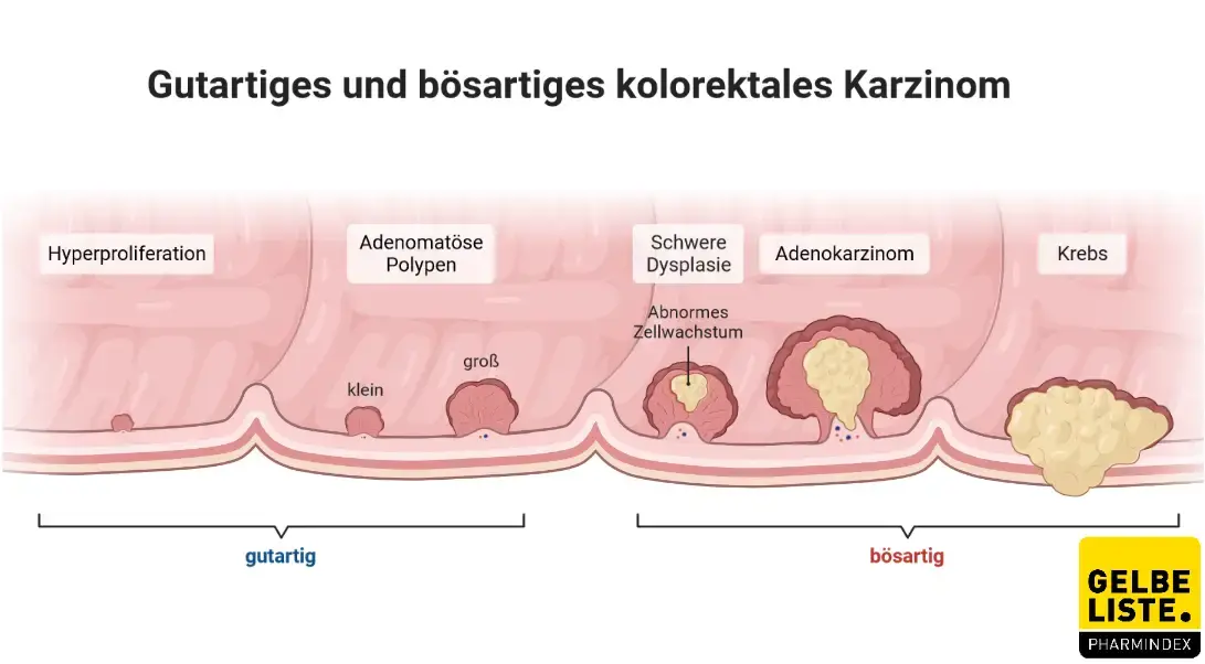 Stadien Und Behandlung Von Darmkrebs